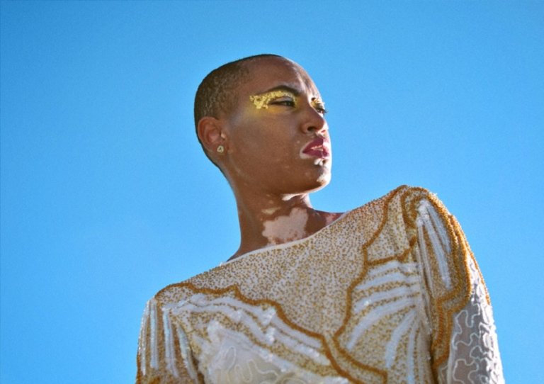 Amy Deanna is first black model with vitiligo to be the face of ...