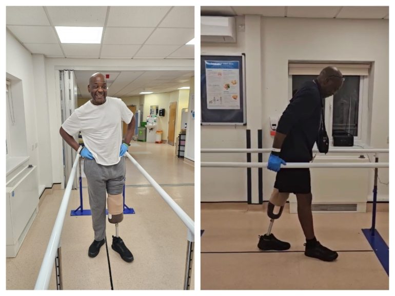 Man’s leg amputated after suffering burns while giving himself pedicure ...